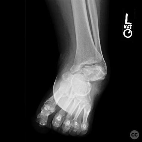 Posterior Talar Body Fracture Dislocation With Medial Subtalar Dislocation