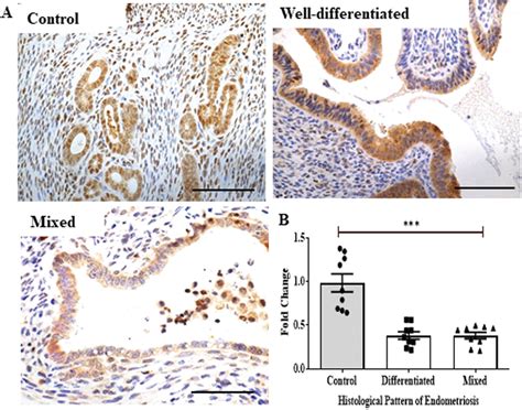 Dynamics Of Hoxa10 Expression In Ectopic Endometrium Of A Mouse Model