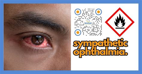 Eye Misalignment Causes Symptoms And Treatment Options For Strabismus