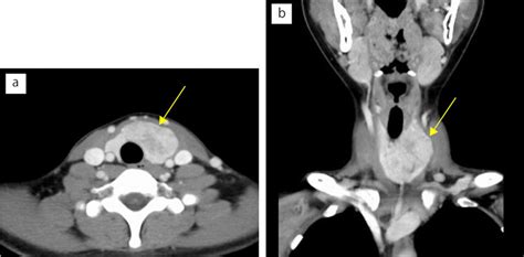 Contrast Enhanced Computed Tomography A B A Nodular Lesion