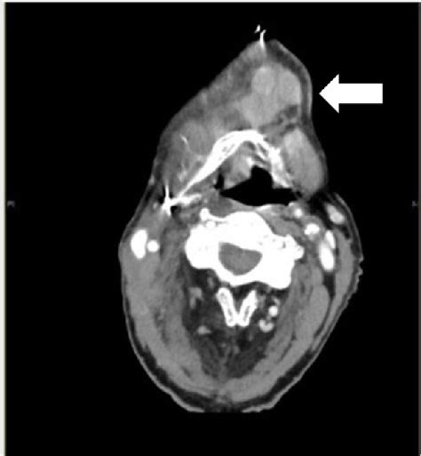 Cat Scan Demonstrating Left Submandibular Merkel Cell Carcinoma Arrow