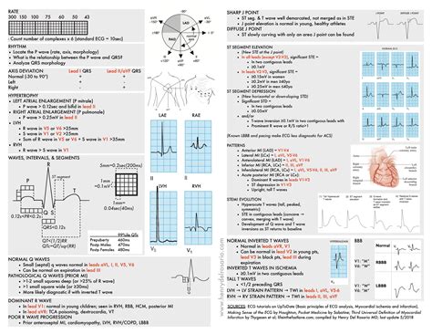 Ekg Interpretation Cheat Sheet Printable