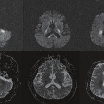 Figure A Diffusion Weighted MRI Shows High Signal Intensity On Download Scientific Diagram