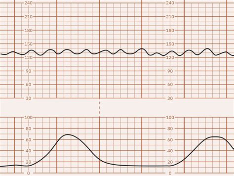 16 1 Basic Terms Of Fetal Heart Rate And Contraction Patterns