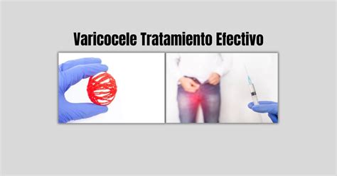 Varicocele Tratamiento Guía Completa Para El Alivio Uroinfo