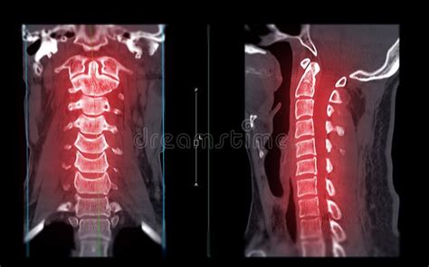 Ct Scan Of Cervical Spine C Spine Stock Illustration Illustration Of