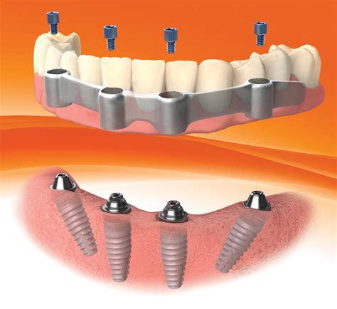 Multi Unit Abutment System Biohorizons Implant Systems