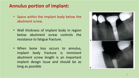 Dental Implant Designs Pptx