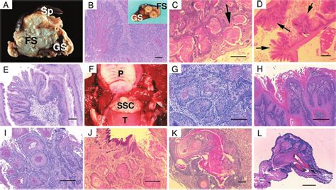 Squamous Cell Carcinomas And Papillomas Of Keratinized Epithelial