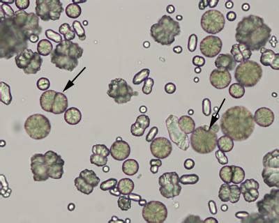 Calcium Carbonate Crystals Medical Laboratories