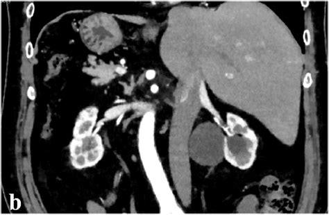B Ct Findings With 46mm Exophytic Renal Mass At The Left Renal Hilum Download Scientific