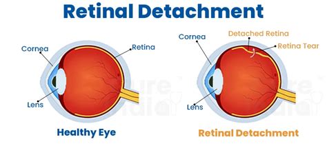 Retinal Detachment Surgery In India Expert Ophthalmologists