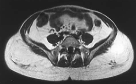 Lipoatrophic—lipodystrophic Syndromes The Spectrum Of Findings On Mr