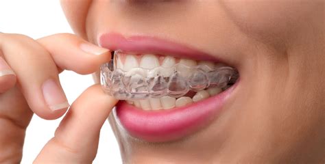 Bruxismo y cómo tratarlo Clínica Dental Fernández Ayora