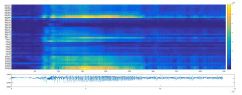 Github Roschkoenig Seeg Network Using Network Modelling To Identify Targets For Epilepsy Surgery