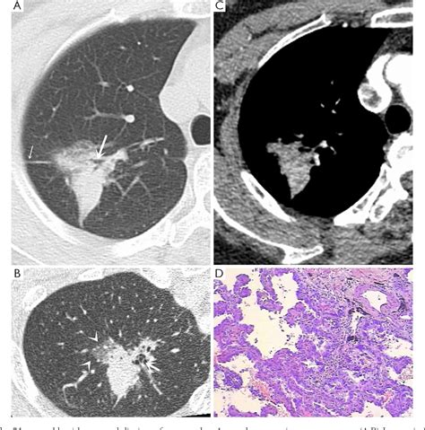 Figure 1 From Differentiation Of Localized Pneumonic Type Lung