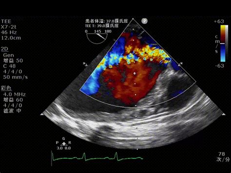Pioneer Tavr