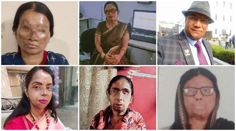Surgeries Little Compensation Lengthy Cases 6 Acid Attack Victims