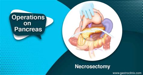 Necrosectomy Dr Harsh J Shah