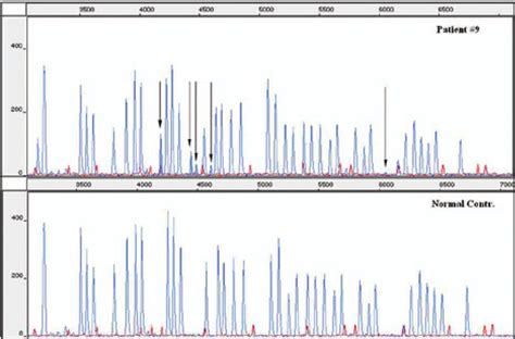 Mlpa Analysis Methylation Test Of Fmr1 Gene Hha I Restriction Enzyme Download Scientific