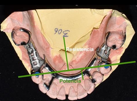 Integral 2015 Dra Cerda Seminario 15 PrÓtesis Removible Rodrigo Osorio Larraín Charlotte