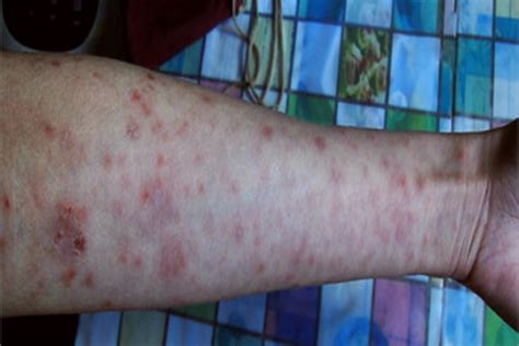 湿疹型药疹胳膊丘疹图片
