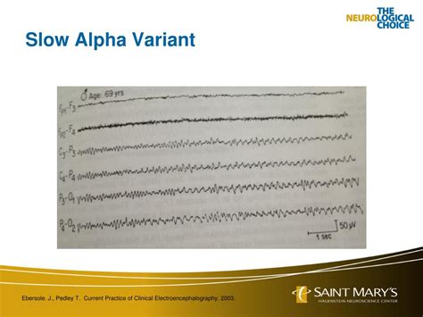 Ppt Benign Eeg Variants And Patterns Of Unknown Significance