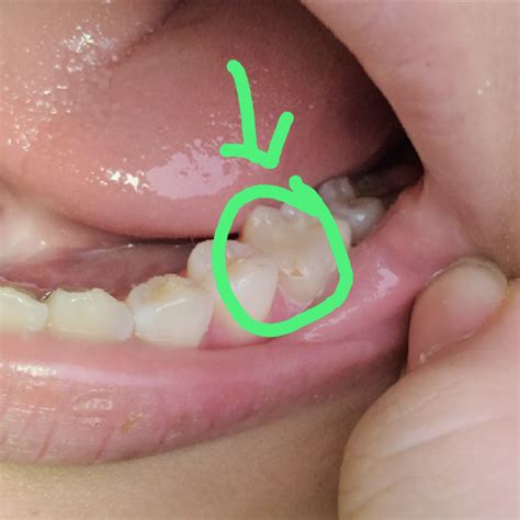 치과 충치 치통 너무 아파요ㅠㅠㅠ 지식in