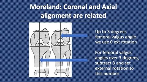 Victor Verbat On Linkedin Most Common External Rotation Is 3 Degrees