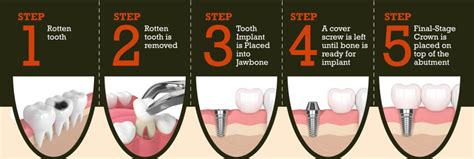 Dental Implant Procedure Step By Step Guide And Timeline