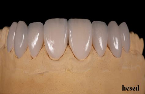 Veneers Vs Crowns Understanding Your Dental Options Userteamnames