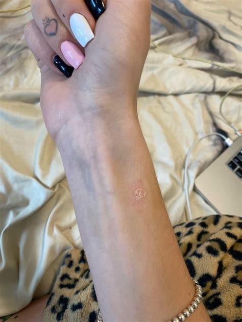 Rosemary Oil Miracle For Scalp Psoriasis R Psoriasis