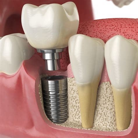 Missing Teeth Flower Mound Tx Dental Implants Dentures