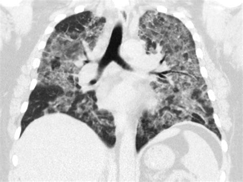 Imaging Experts Give Insight On Vaping Related Lung Injury