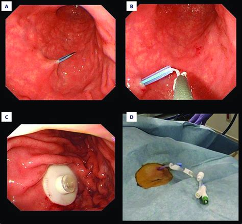 Endoscopy Procedure Video What Is Endoscopy Endoscopic Procedures