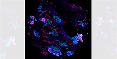 El mapa más amplio del cáncer de pulmón pone el foco en la diversidad