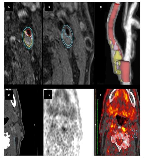 A Carotid Mri Semi Automatic Segmentation Of Lumen And Vessel Wall