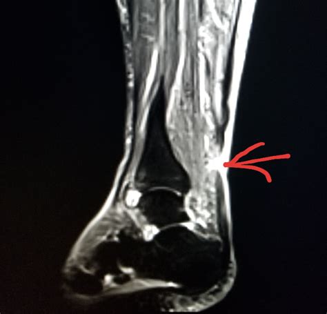 Ankle Mri Torn Achilles Tendon In 78 Yo Woman Who Fell Off A Golf