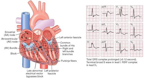 Right Bundle Branch Block Cardiac Nursing Bundle Branch Block