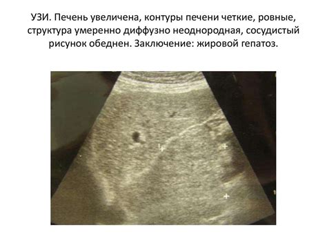 Печень на узи не увеличена а что болит фото презентация