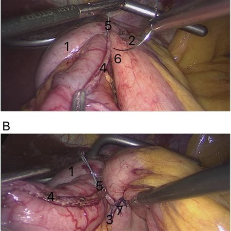 Stitching The Anterior And Posterior Parts Of The Fundoplication Wrap