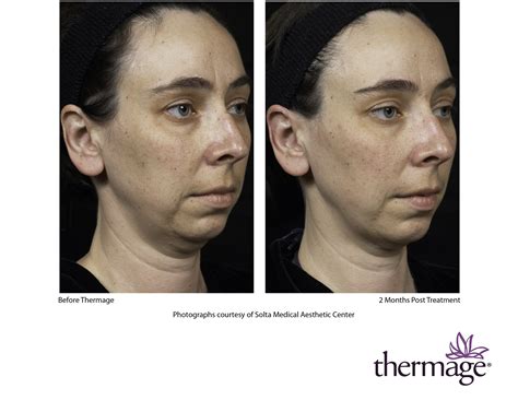 Thermage® Flx Facial And Neck Smoother Skin Awaits — Skin Philosophy