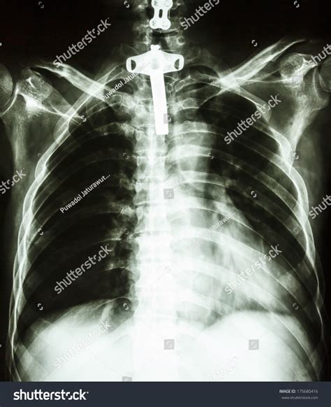 Film Chest Xray Pa Upright Show Stock Photo 175680416 Shutterstock