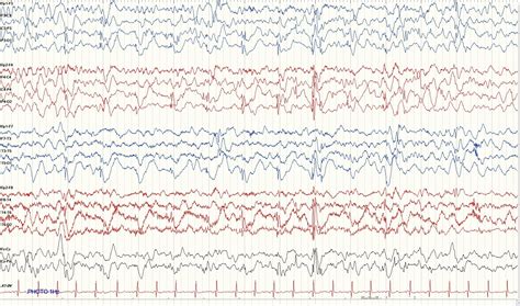 Unique Characteristics Of The Photoparoxysmal Response In Patients With Neuronal Ceroid
