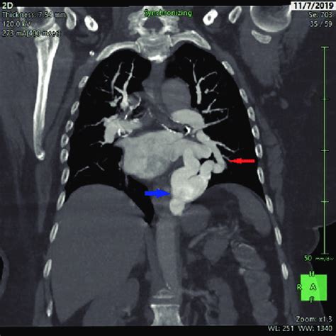 Coronal Contrast Enhanced Computerized Tomography In Pulmonary Arterial