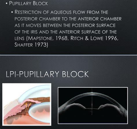 Laser Therapy For Angle Closure Glaucomas Flashcards Quizlet