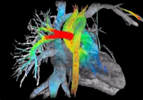 Cosè La Risonanza Magnetica Cardiaca