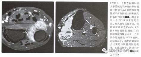 一文读懂色素沉着绒毛结节性滑膜炎PVNS MedSci cn