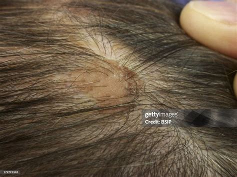 Seborrheic Keratosis Wart On Scalp News Photo Getty Images