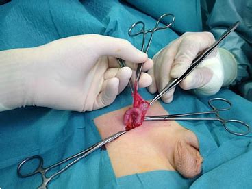 Photograph Of The Normal Vermiform Appendix On Opening Of Download Scientific Diagram